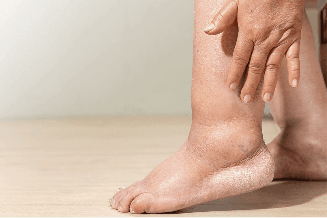 Oedema: Causes, Symptoms & Treatment Options