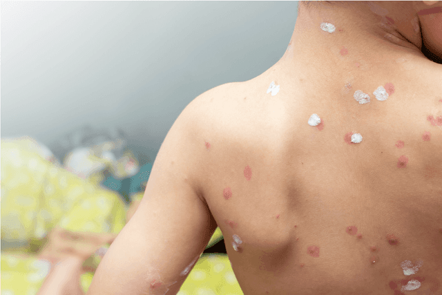 Chickenpox: Symptoms, Treatment, Prevention & Recovery Tips