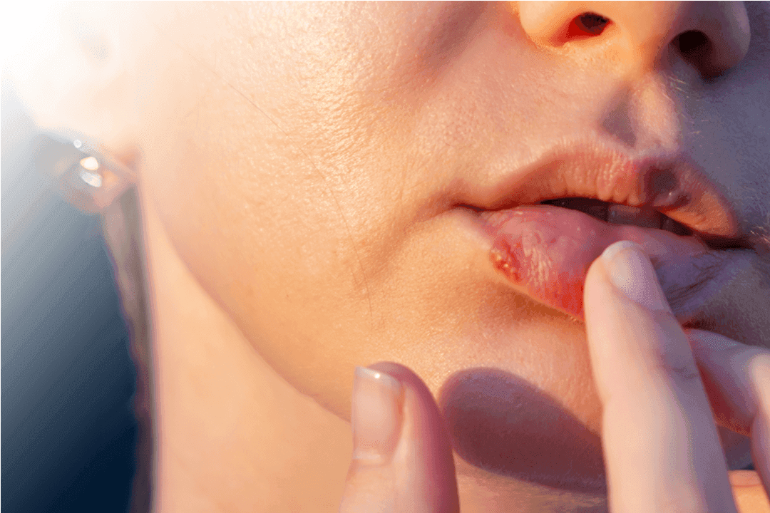 Herpes Labialis: Causes, Symptoms & Treatment