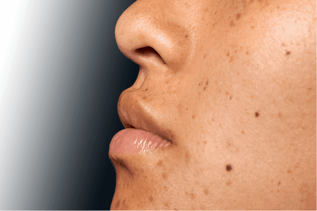 Liver Spot: Causes, Symptoms, and Effective Treatment Options