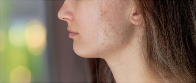 Melasma: Causes, Symptoms & Treatment Options