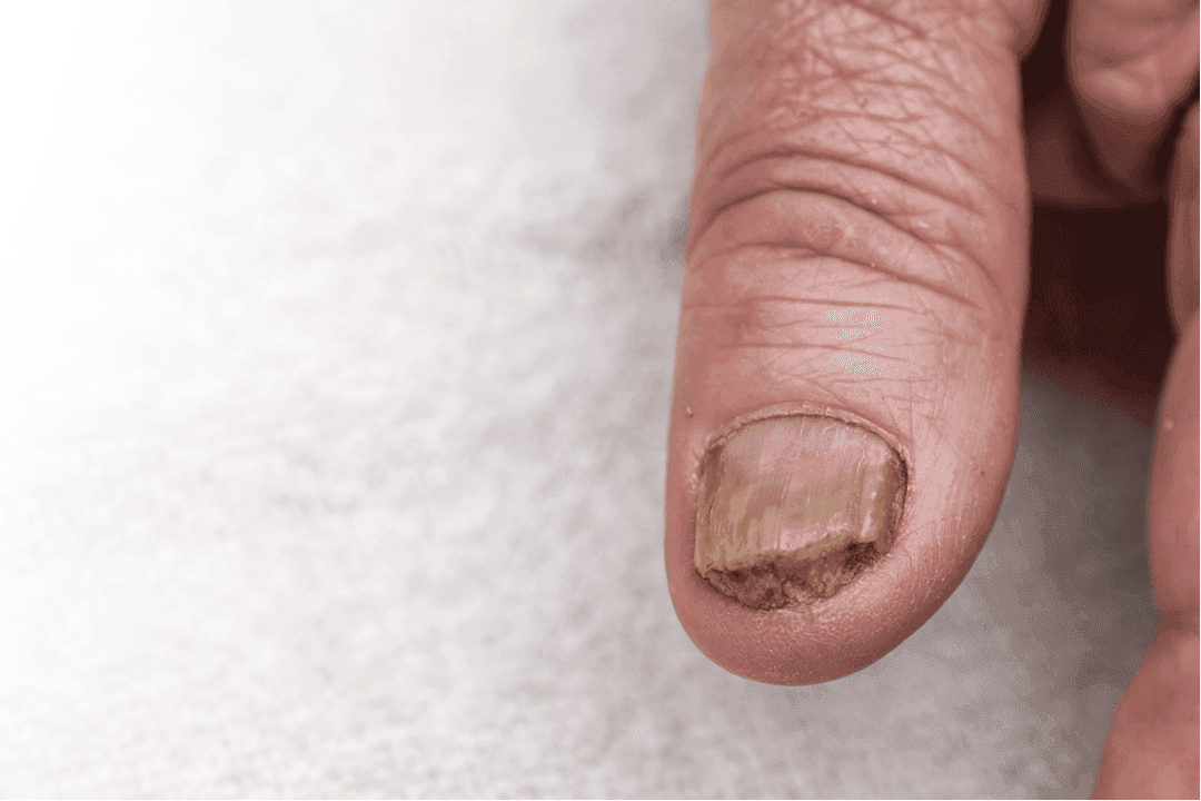 Paronychia: Causes, Symptoms & Treatment Options