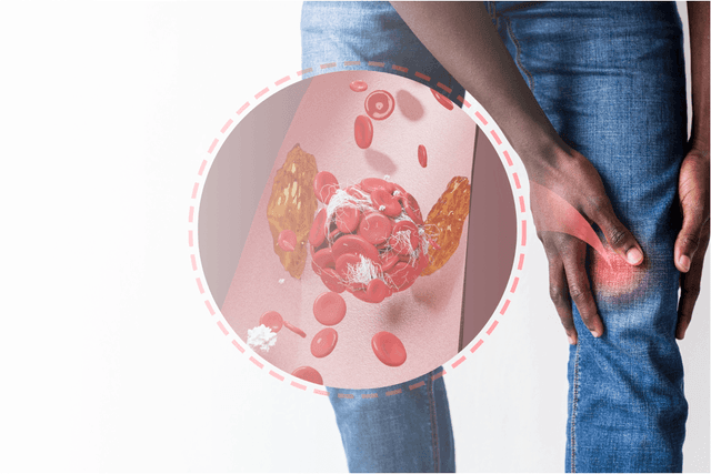 Peripheral Artery Disease: Symptoms, Causes & Treatment Options