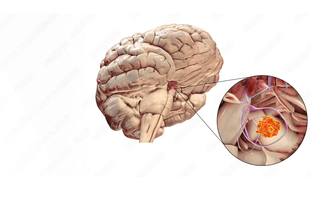 Prolactinoma: Causes, Symptoms & Treatment Options