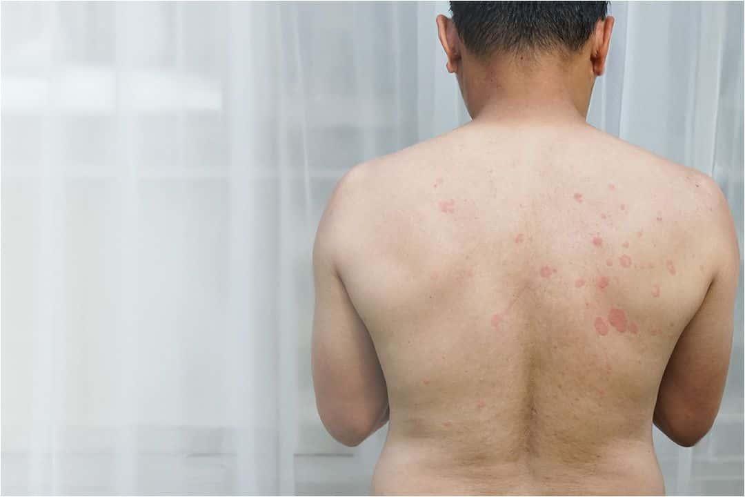 Ringworm on Body: Causes, Symptoms & Effective Treatments