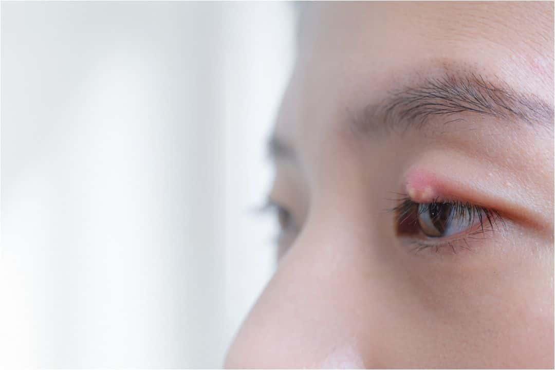 Stye: Causes, Symptoms & Effective Treatment Options
